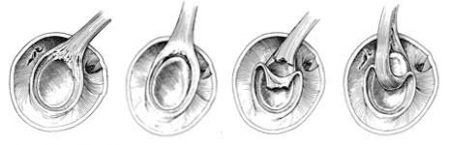 What Exactly Is a SLAP Tear? Top 5 Things You Need to Know