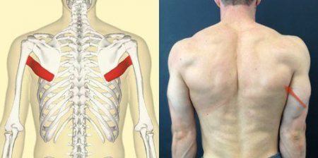 Teres Major: An Important Muscle that is Often Overlooked